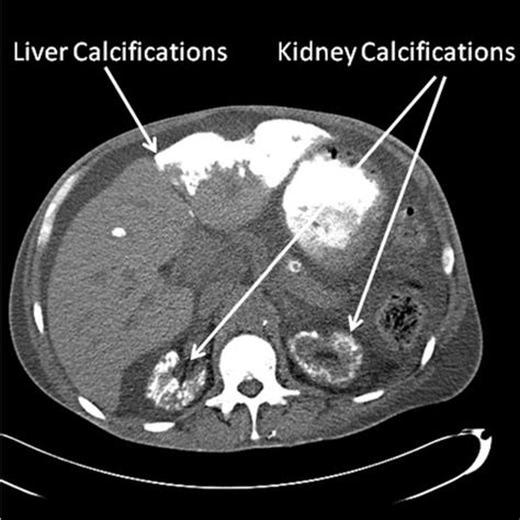 Ct Of The Abdomen With Po Contrast Arrow Shows Liver Calcifications Download Scientific Diagram