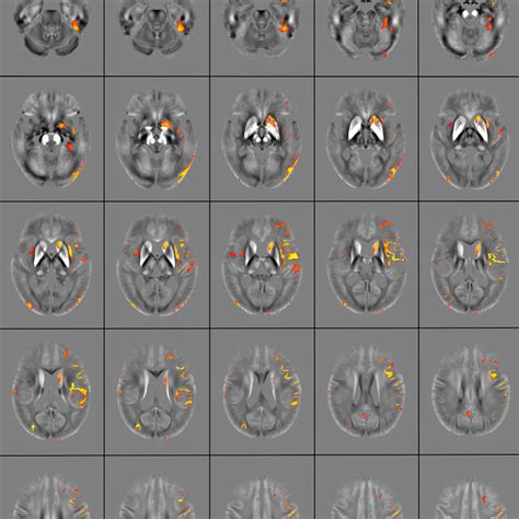 Results From Whole Brain Absolute Qsm Analysis Red Yellow Clusters Download Scientific Diagram