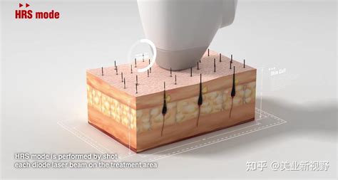 808激光脱毛仪 科普808nm激光冰点脱毛原理 知乎