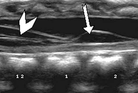 Conus Medullaris Ultrasound