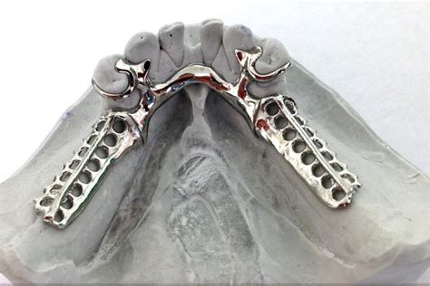 Mcdowell And Service Cobalt Chrome Frameworks Mcdowell