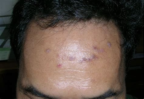 神经性皮炎症状的图片有来医生