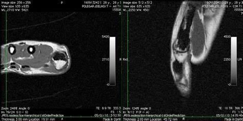 Mri Hyperostosis Characteristic Of Melorheostosis Demonstrated On All