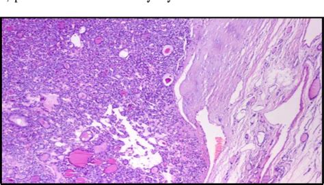 Multinodular Goiter Histology