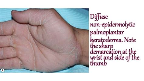 Palmoplantar Keratodermas Pptx