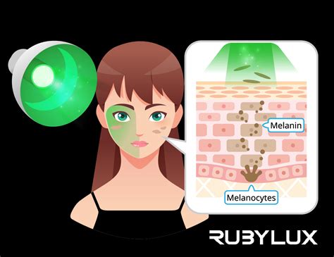 Green Light Therapy For Hyperpigmentation And Age Spots Rubyluxlights