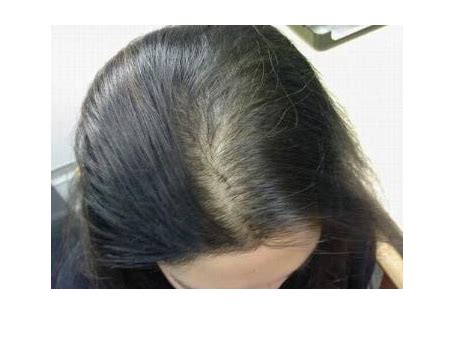 脂溢性脱发应该如何正确的治疗