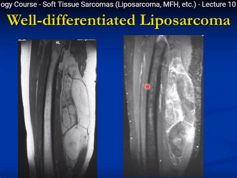 Soft Tissue Sarcomas —