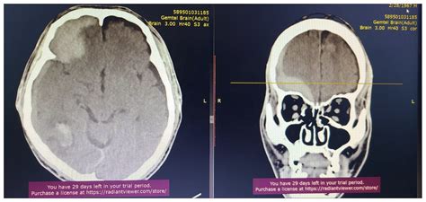 ГССҮТ Гавал тархины гэмтлийн дурангийн мэс заслыг амжилттай нэвтрүүллээ Humanz