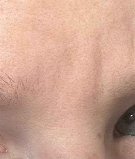 how to get rid of this indented scarring that makes me look angry worried all the time r