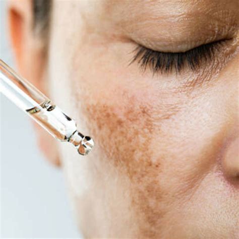 Melasma Treatment Bio Plastic Surgery Clinic