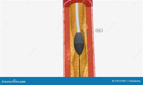 Atherectomy Is A Minimally Invasive Procedure That Removes Plaque Using