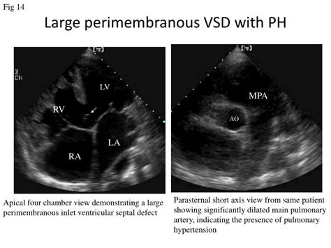 Ppt Ventricular Septal Defects Powerpoint Presentation Id 1817608