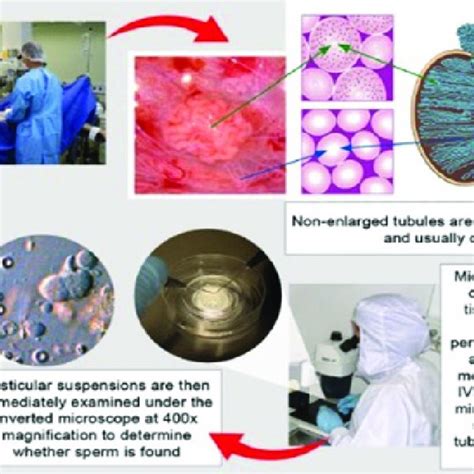 Courtesy 62 Microdissection Testicular Sperm Extraction The
