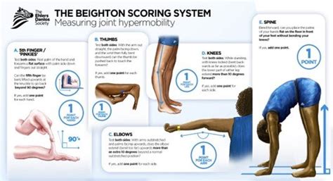 Hypermobility What Does It Mean If Your Joints Are Too Flexibile