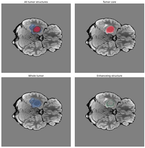 Multimodal 3d Brain Tumor Segmentation With Azure Ml And Monai Towards Data Science