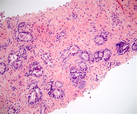Pathology Outlines Basal Cell Hyperplasia