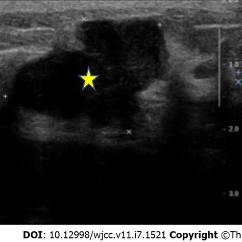 A Partial Circumscribed Lobular Mass Red Star Sized Approximately
