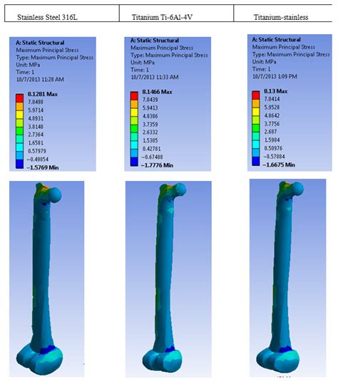 Finite Element Analysis And Simulation Of 316l Stainless Steel And Titanium Alloy For Orthopedic