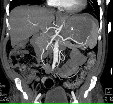 Gastric Gist Tumor Stomach Case Studies Ctisus Ct Scanning
