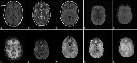 Multi Contrast Echo Planar Imaging Sequence Echo Planar Imaging Mix
