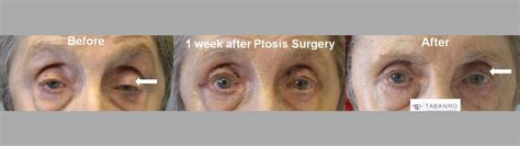 Ptosis Surgery Beverly Hills Droopy Eyelid Surgery Los Angeles