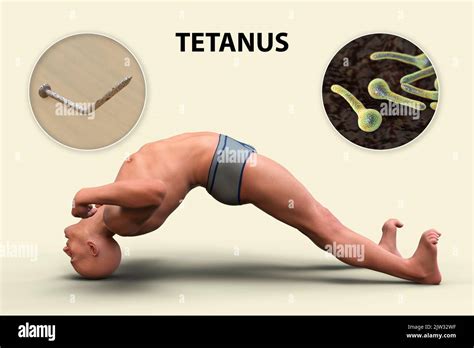 Tetanus Causes