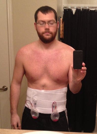 Xiphoid Process Lump