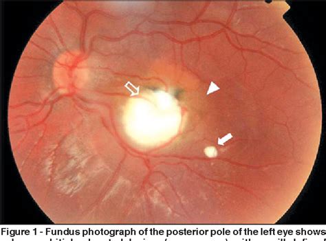 Toxocara Canis Retina