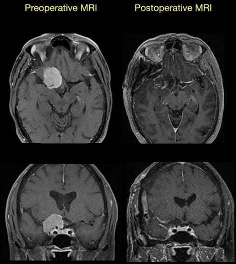 Role Of Extradural Clinoidectomy And Optic Unroofing In Resection Of An
