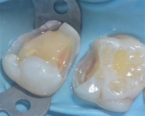 Lesson 3 Immediate Dentin Sealing And Resin Coating — Alleman Center