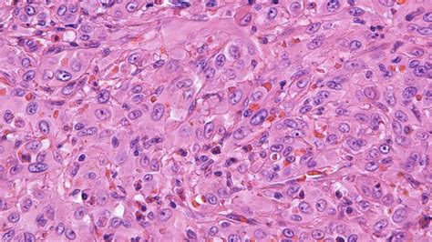 Epithelioid Angiosarcoma Ottawa Atlas Of Pathology