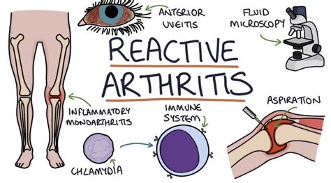 Reactive Arthritis Causes Archives Samarpan Physiotherapy Clinic