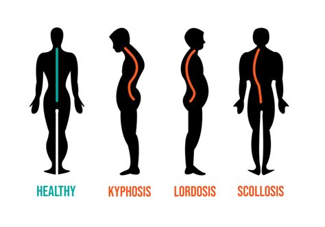 What Is Postural Alignment Pain Free Chronic Therapy What Is Postural Alignment Pain Free Chronic Therapy