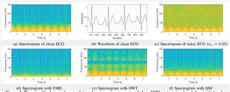 Figure from A Complexity Eﬃcient Penta Diagonal Quantum Smoothing Filter for ECG Signal