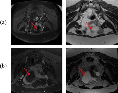 Figure 1 From A Dynamic Multi Modal Fusion Network For Ovarian Tumor Differentiation Semantic