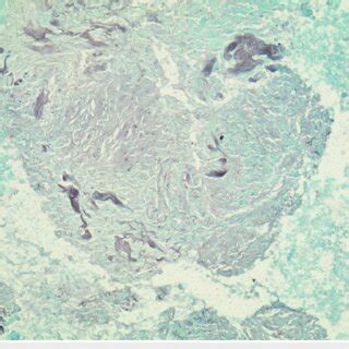 Histological Slide From The EBUS TBNA Showing A Noncaseating Granuloma