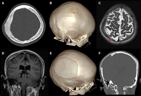 Preoperative Images A Axial Thin Cut Skull Ct Shows An Osteogenic