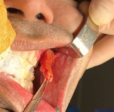 Male Left Buccal Lipectomy Dr Barry Eppley Explore Plastic Surgery