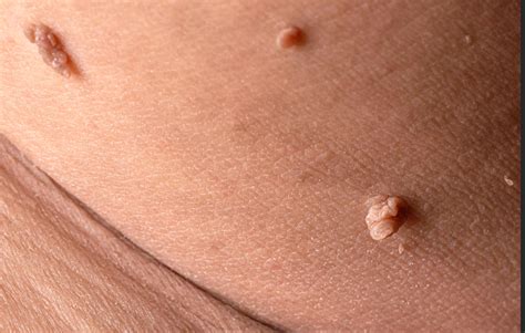 Τι είναι τα κονδυλώματα 60