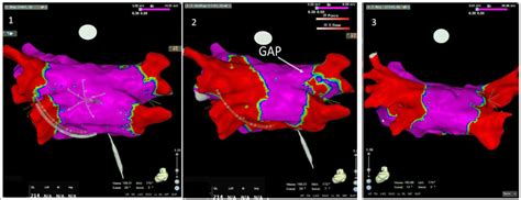 Electroanatomic Mapping Using A High Density Mapping Catheter