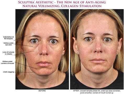 Sculptra Before And After