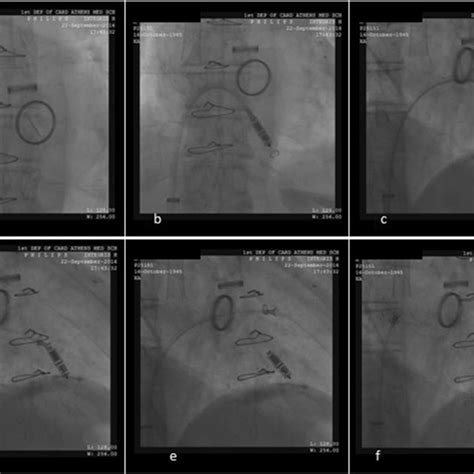 Snapshots From The Implantation Procedure Of The Leadless Pacing System Download Scientific