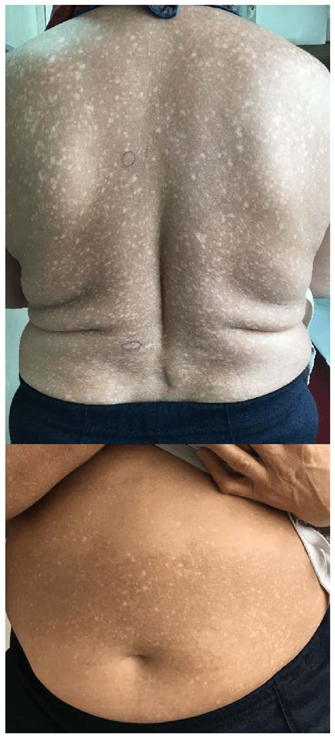 Diffuse Band Like Hyperpigmentation Located On The Upper Quadrant Of