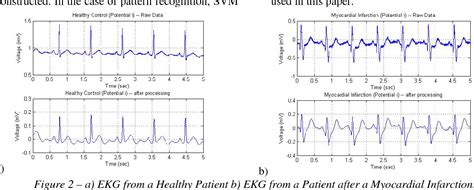 Table 1 From Ekg Feature Extraction And Classification For Myocardial Infarction Diagnosis