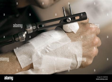 Fracture Arm High Resolution Stock Photography And Images Alamy