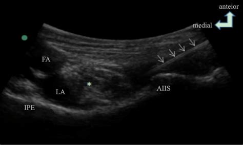 Representative Image And Ultrasound Scan Of Patient Receiving Peng Download Scientific Diagram