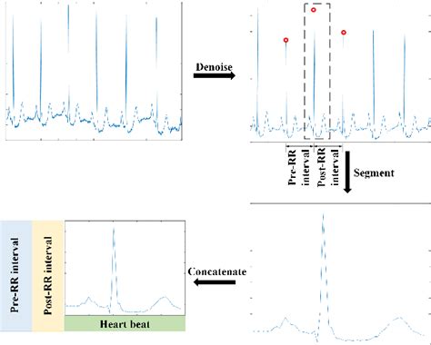 Figure 1 From A Dual Arrhythmia Classification Algorithm Based On Deep