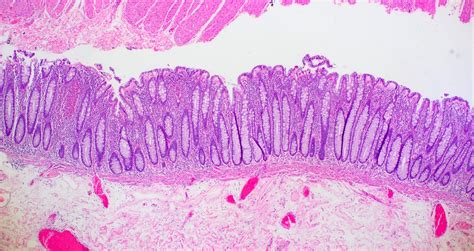 Pathology Outlines Acute Self Limited Colitis