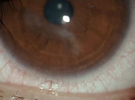 Phlyctenular Keratoconjunctivitis A Teaching Case Report The Journal Of Optometric Education